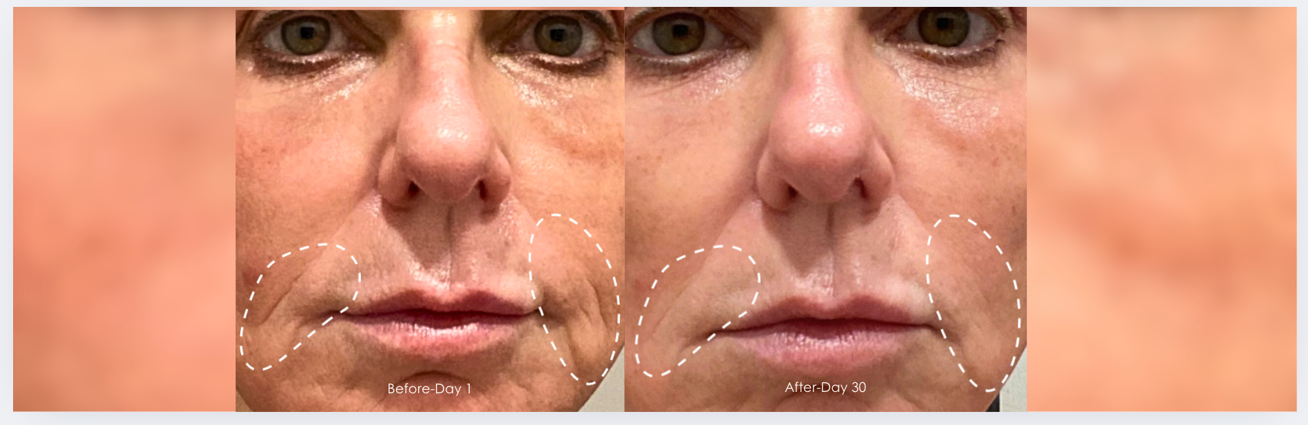 Reva: The Best At-Home Skin Tightening Wand For Aging Skin | Project E ...